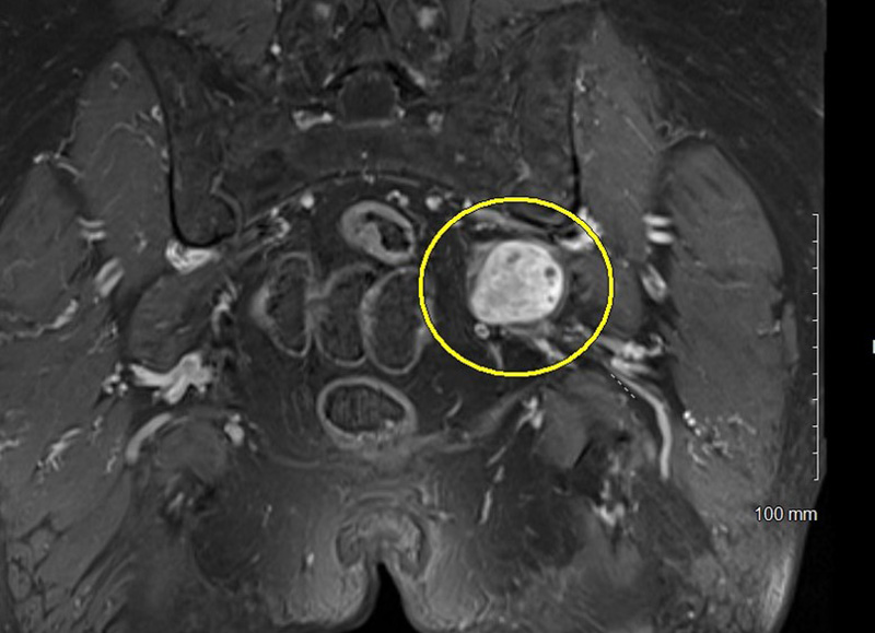 Sciatic neuropathy case study: 4-centimeter tumor discovered on sciatic ...